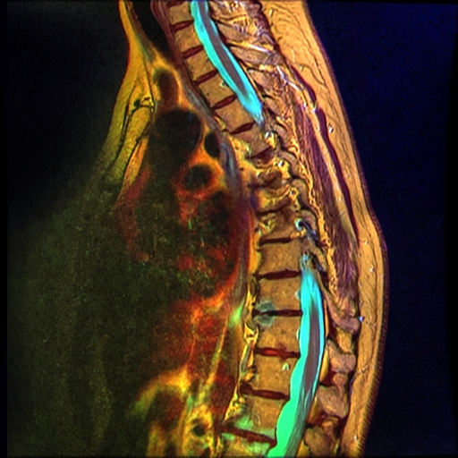 Nevit's blog: Dorsal Spine Color MRI