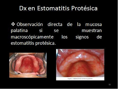 PROSTODONCIA TOTAL: Estomatitis protesica