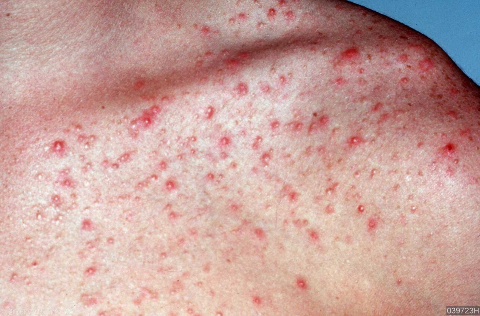 SKIN DISEASE TYPES: Folliculitis Skin Disease Type (Skin Disease Type)