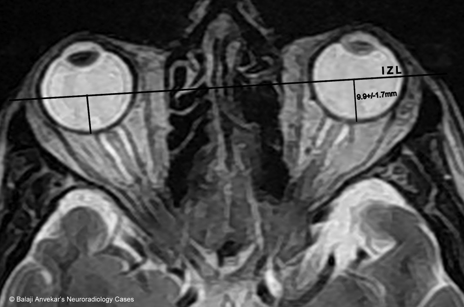 Dr Balaji Anvekar FRCR: Diagnostic Criteria for Orbital Proptosis