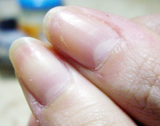 Levels of Nicotine on Finger Nails to Predict Lung Cancer ~ Healthy ...