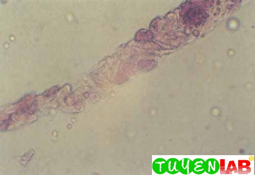 Atlas of Casts in urine | Free Medical Atlas