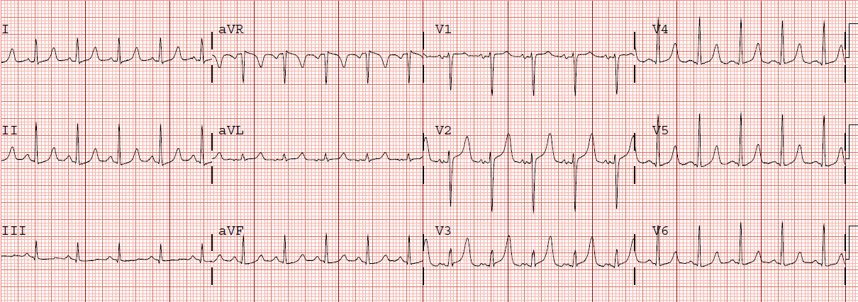 Dr. Smith's ECG Blog: Slightly Peaked T-waves, What is it?