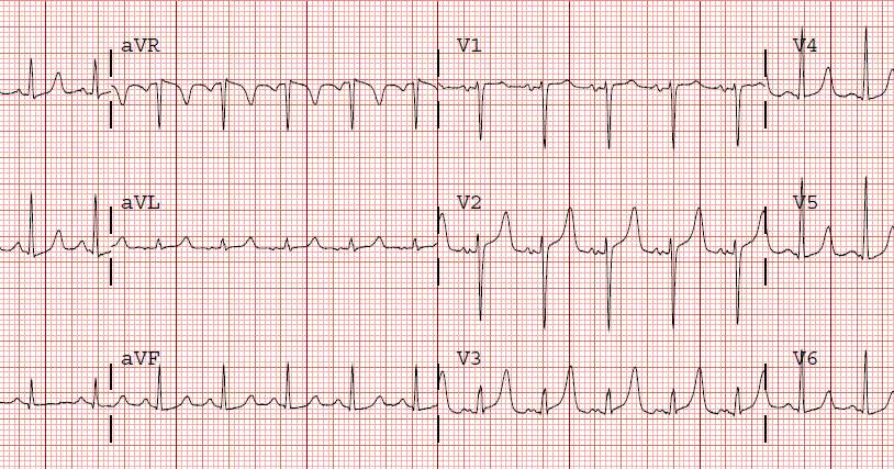 Dr. Smith's ECG Blog: Slightly Peaked T-waves, What is it?