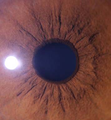 Modern & Multidimensional Iridology: Iris Signs in Modern Iridology ...
