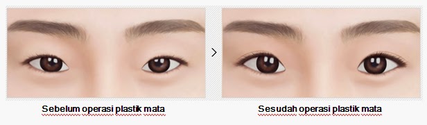 Sinar Mata Mempesona Dengan Operasi Plastik Mata - SlideGossip