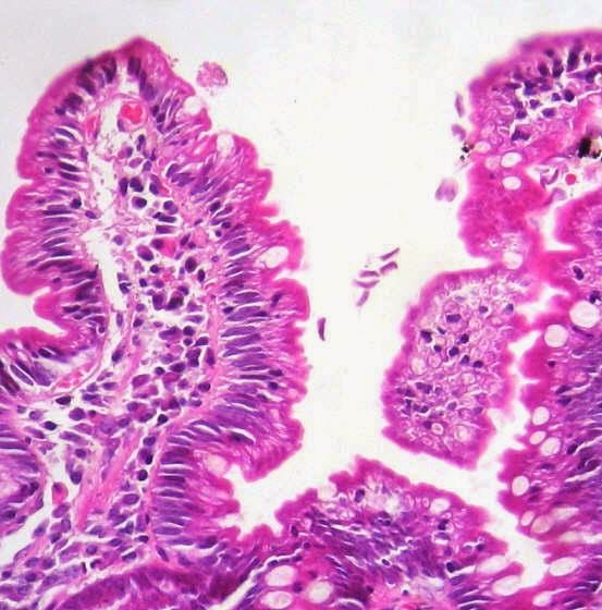 GASTROINTESTINAL AND LIVER HISTOLOGY PATHOLOGY ATLAS: DUODENUM : GIARDIASIS