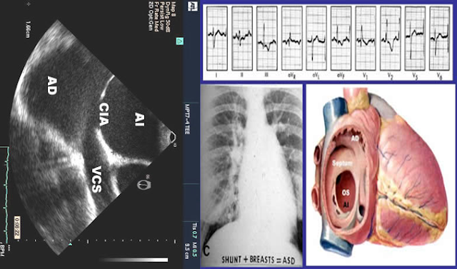 CARDIOPATIAS CONGÉNITAS: Comunicación interauricular: COMUNICACIÓN ...