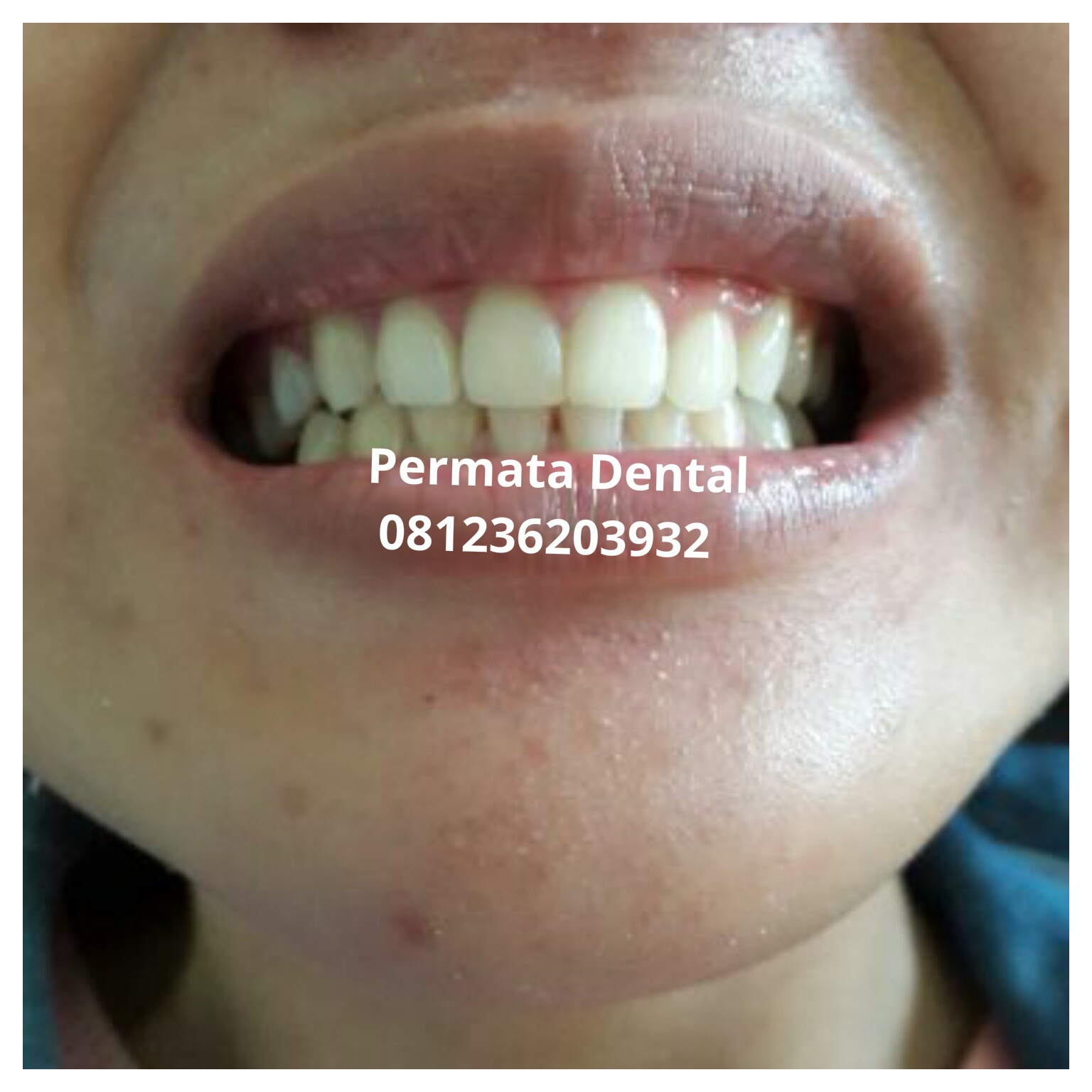 DOKTER GIGI BALI: Veneer Gigi | Samsung Gigi