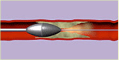 Non Invasive Heart Care