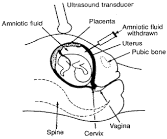 hEiDiMatEs - MeDICinE: Procedures / active intervention in twin to twin ...