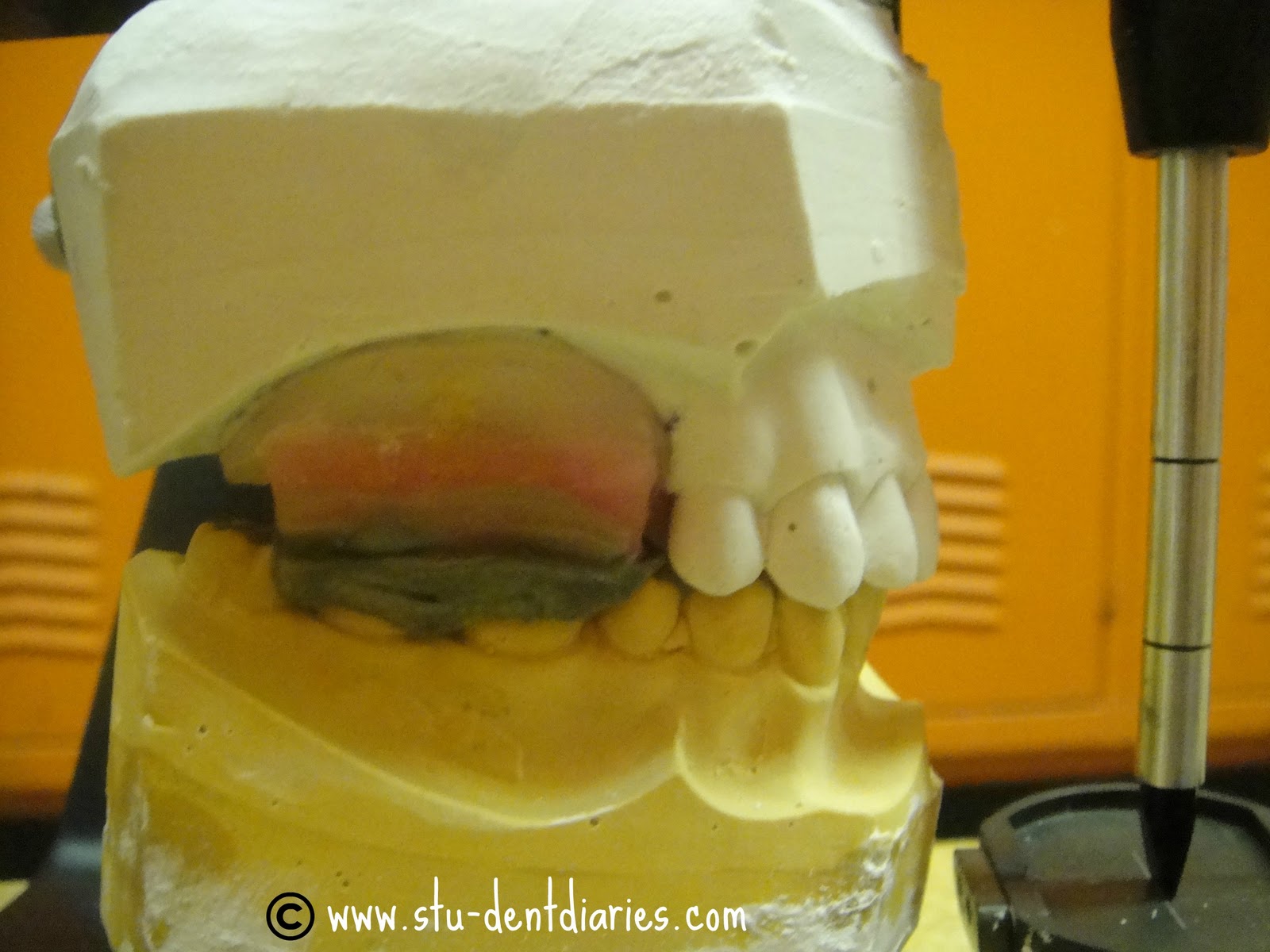 Stu-DENT Diaries: Fabrication of Removable Partial Dentures