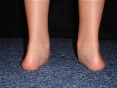 Foot Medic Podiatry Glasgow: Over pronation
