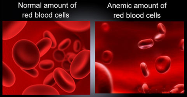 Mediculture: Iron deficiency anemia