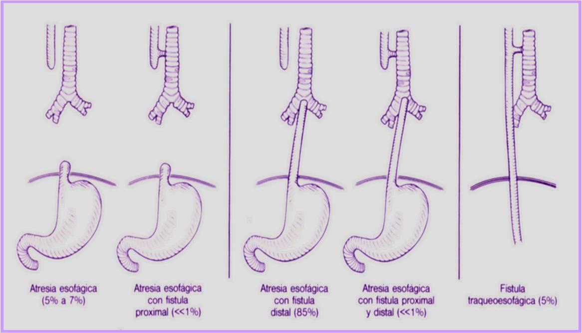 ciencia medica: Atresia Duodenal