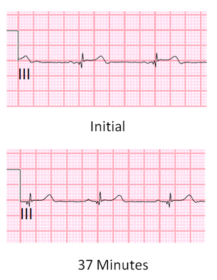 Dr. Smith's ECG Blog: May 2013