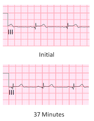 Dr. Smith's ECG Blog: Atypical Chest Pain: Suspicious ECG, and a Left ...