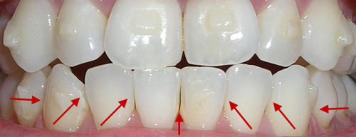 Sneek's Invisalign Treatment: My Interproximal Reduction (Shaving Tooth ...