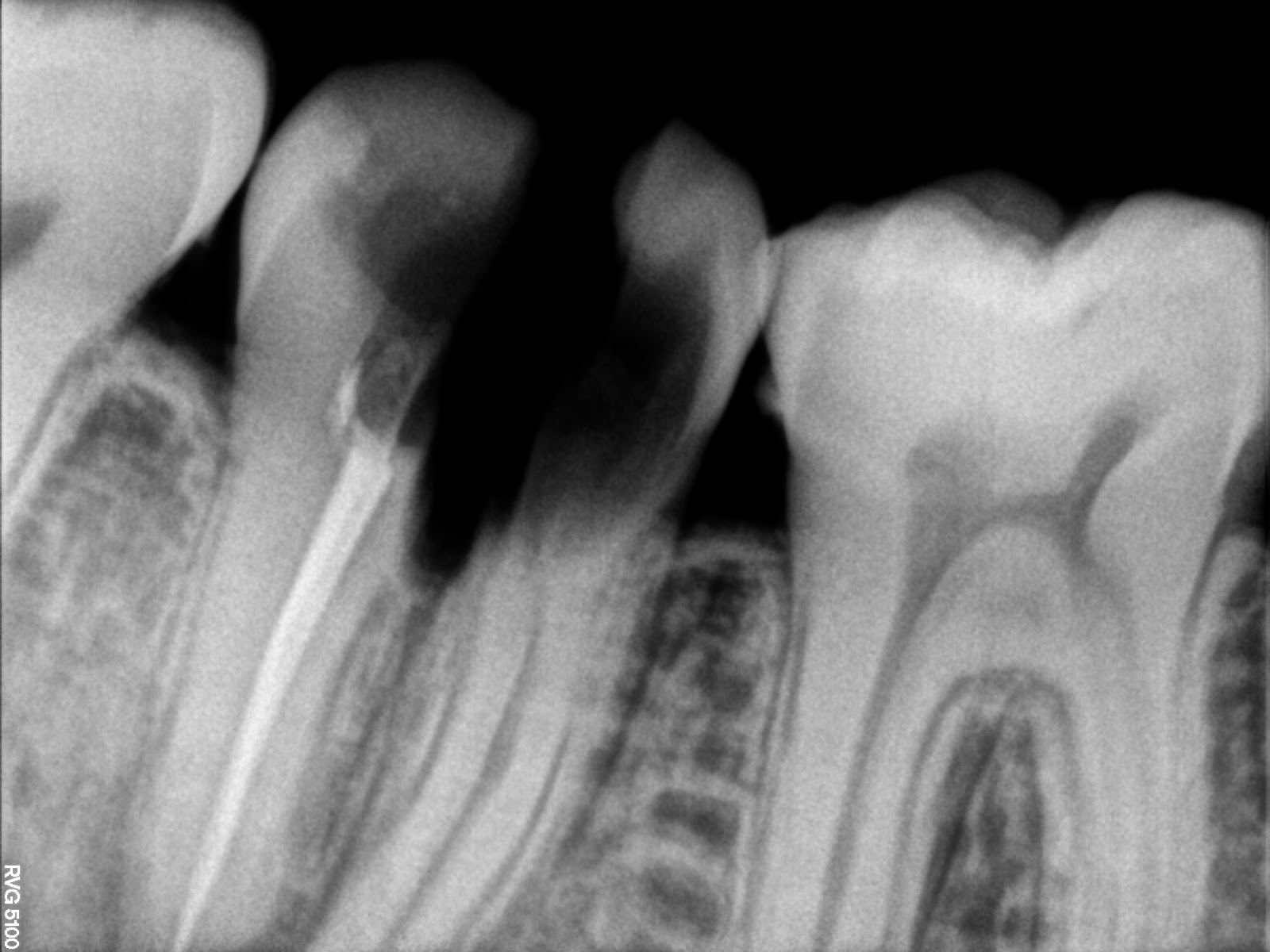 SevaDharma Dental Clinic: RVGs of Hemisection case