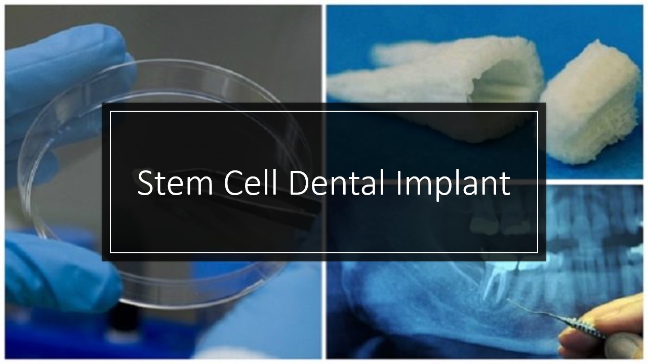 Stem Cell Dental Implants might one day be alternative to Dental ...