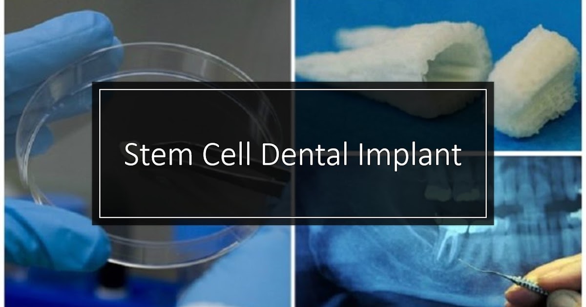 Stem Cell Dental Implants might one day be alternative to Dental ...