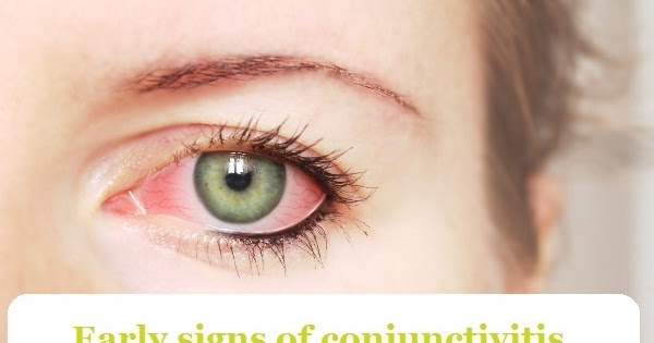 Early Signs of Conjunctivitis - Health Blog - Explore Content About ...