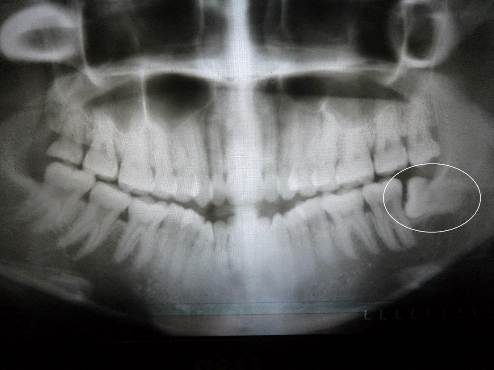 Yuanita Prabawati: 2nd Odontectomy (Oral Surgery)