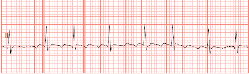 Basic EKG Rhythm Test 45