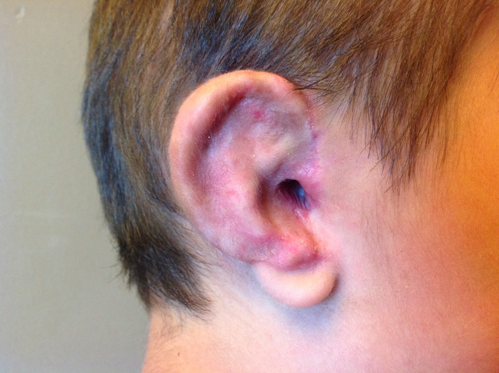 Microtia: Microtia Rib Cartliage Ear Surgery done in only ONE surgery!