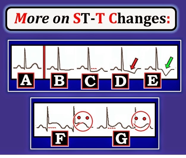 QRST changes : 네이버 블로그