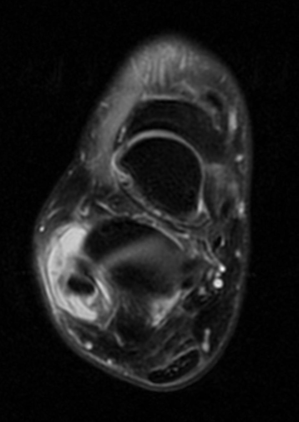Split Peroneus Brevis Tendon-MRI - Sumer's Radiology Blog