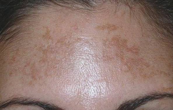 THE SKIN GURUS: Managing Pigment in Ethnic Skin Types