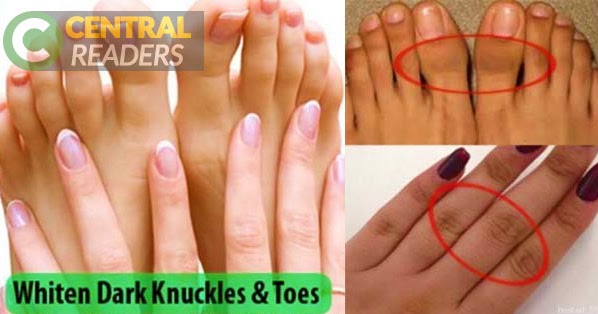 How To Get Rid Of Dark Knuckles And Toes Naturally