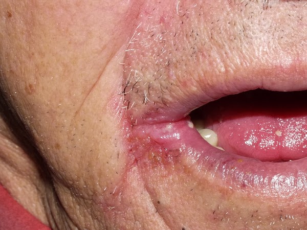 Queilitis angular o Boqueras: Causas comunes de la queilitis angular o ...