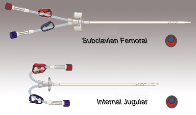Femoral versus Jugular: part three - Renal Fellow Network