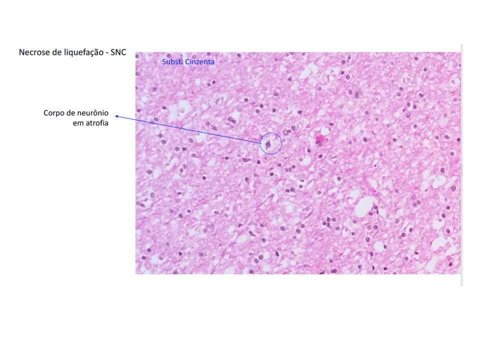 HISTOLOGIA90: TIPOS DE NECROSE