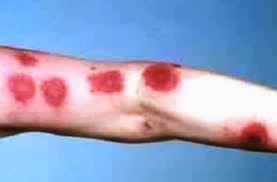 How Signs and Symptoms of Leukemia