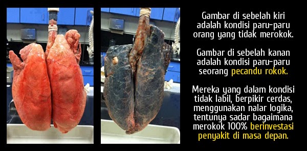 Mencari Tahu Penyakit Paru Paru Akibat Merokok