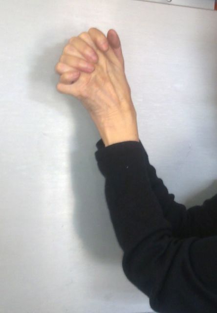 Handrehabilitationcase with Dupuytren's contracture.: A trauma in the ...