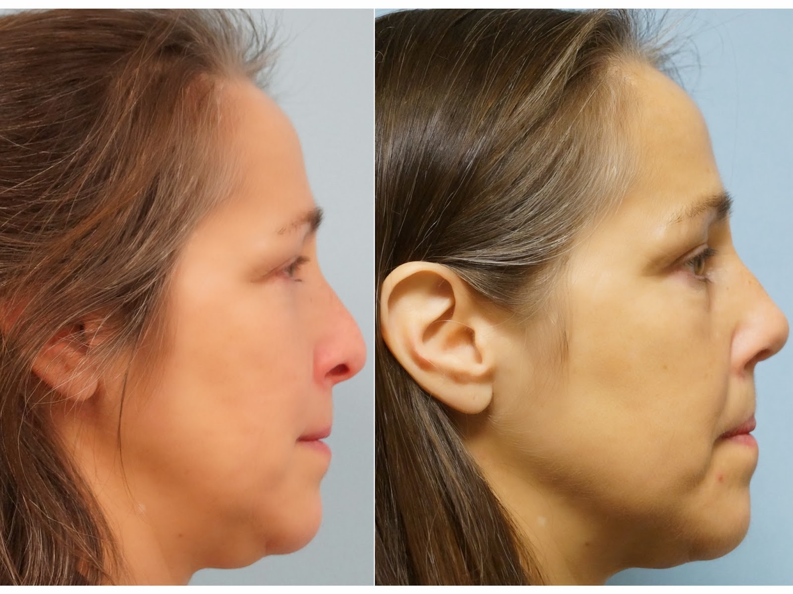 Facial Plastic Surgery: Septal perforation repair, Rhinoplasty ...