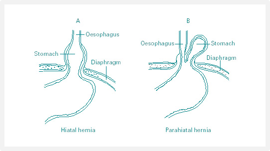 Hiatus Hernia Info: Hiatus Hernia Symptoms & Treatment