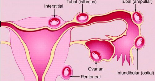 LAPORAN PENDAHULUAN KEHAMILAN EKTOPIK (KEHAMILAN DI LUAR RAHIM)