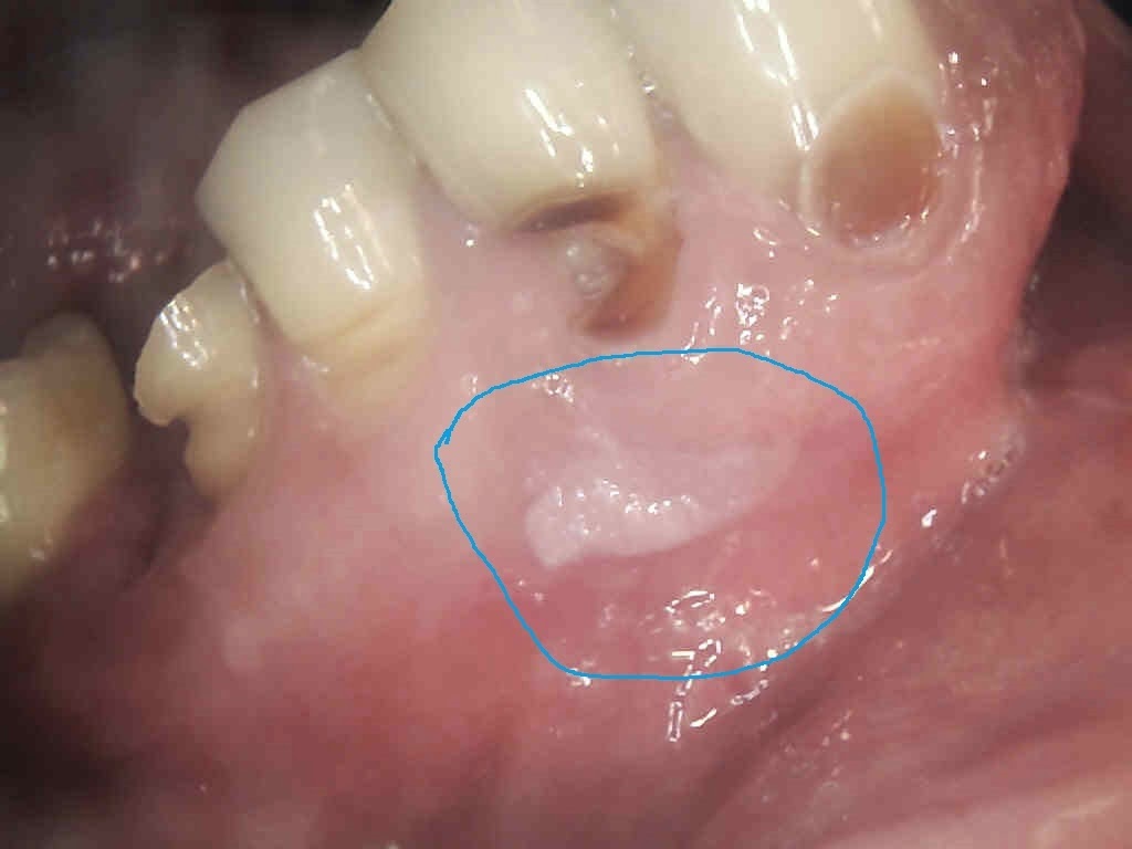 All Things Dental There s This White Spot In My Mouth But It Doesn t all-things-dental-there-s-this-white-spot-in-my-mouth-but-it-doesn-t