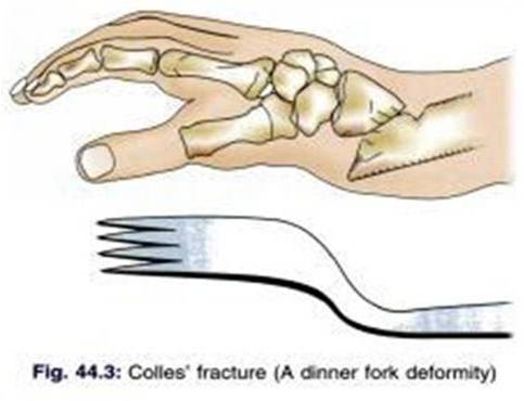 Colles fraktur