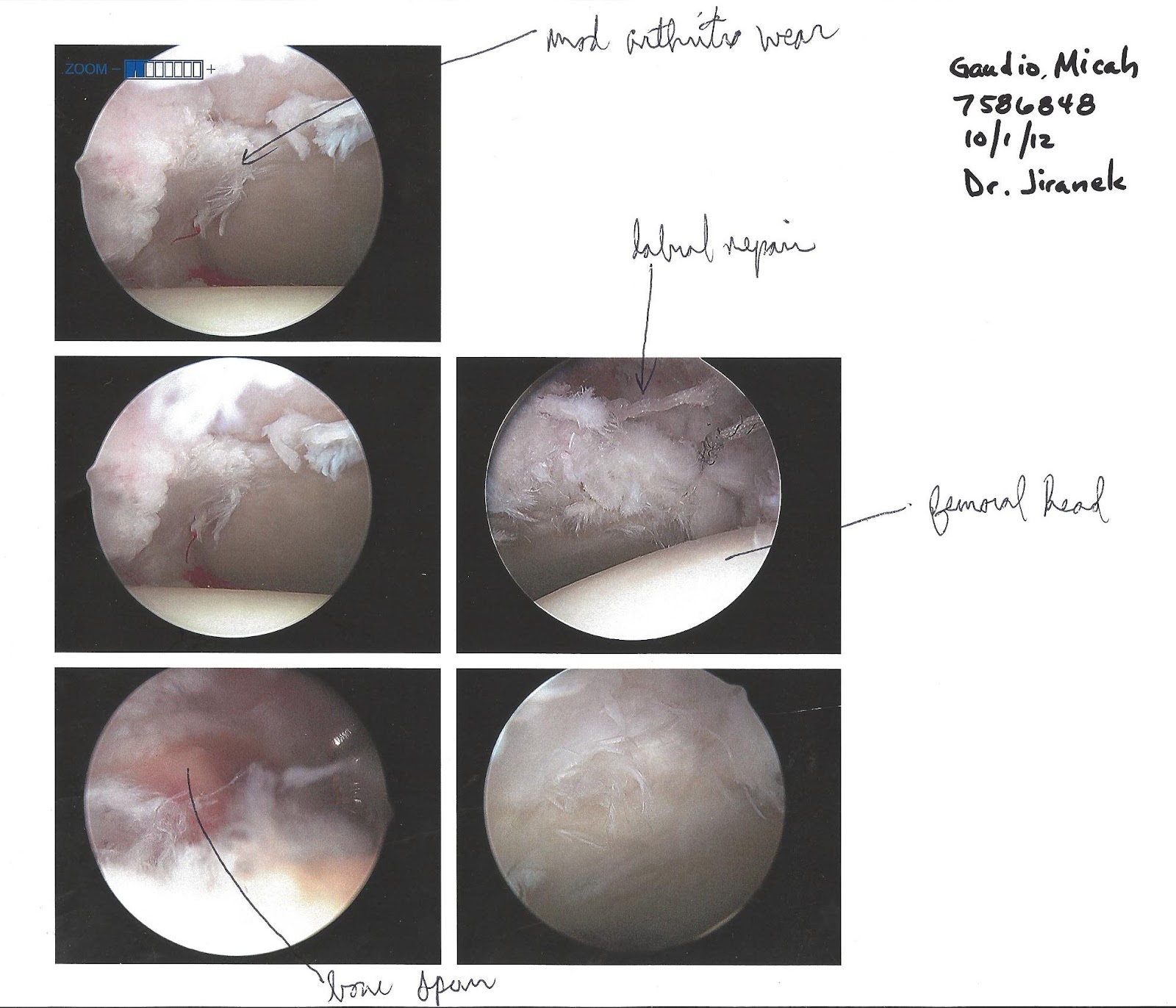 Hip Labral Tear Repair Impingment FAI Arthroscopic Surgery Dysplasia