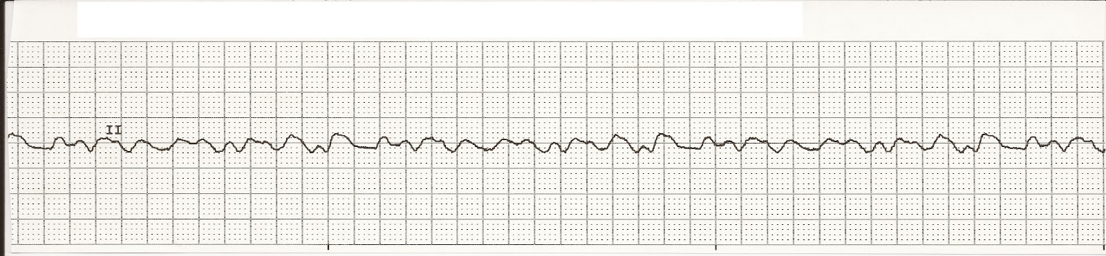 EKG Rhythm Strips 12- ventricular rhythms