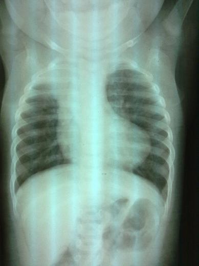 Radiology Residency Notes: Pediatrics: Tetralogy of Fallot