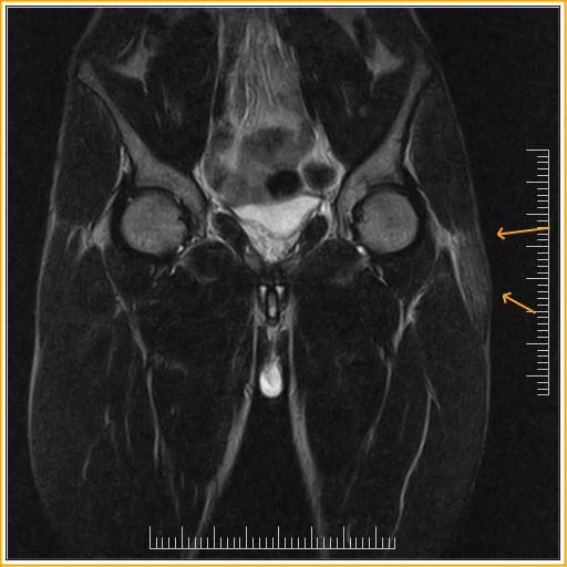 Tensor Fascia Latae Strain - Sumer's Radiology Blog