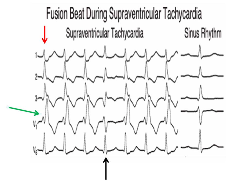 Dr. Smith's ECG Blog: Fusion Beat During Supraventricular Tachycardia ...