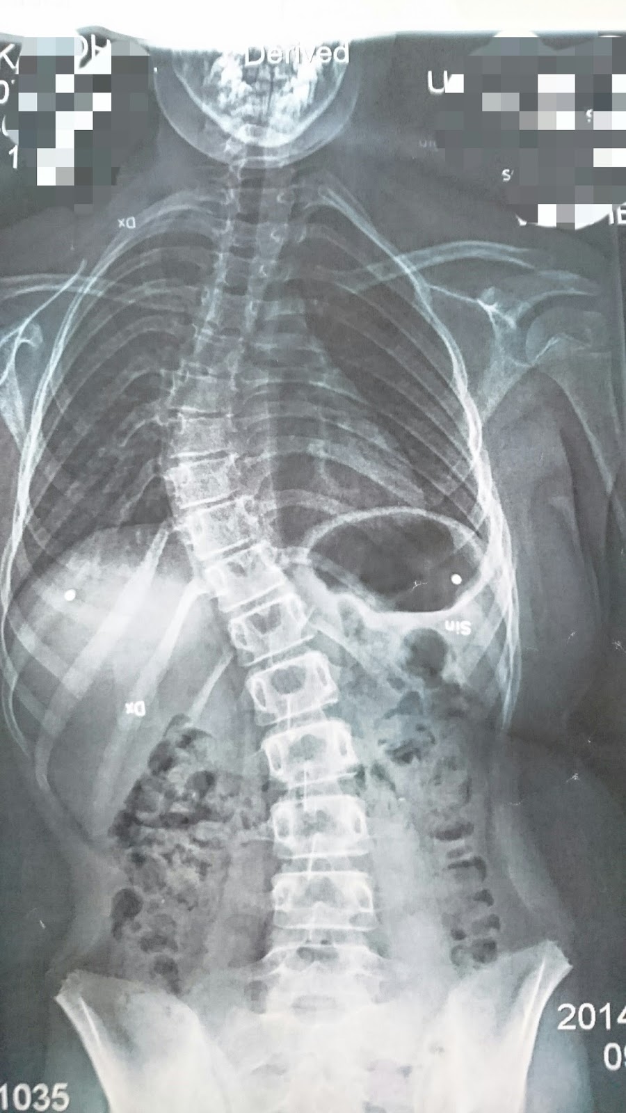 Skoliosoperation: när man hittade min skolios